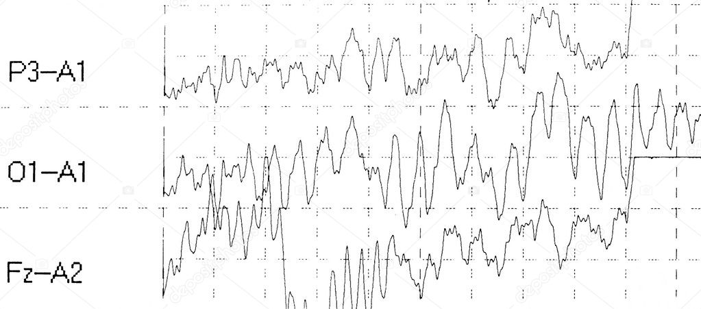 Graph brain wave EEG isolated on white background — Stock Photo ...