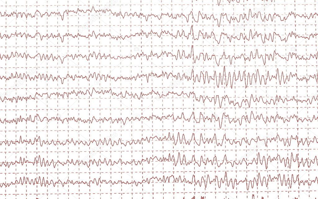 Electroencephalogram Definition